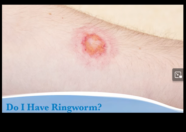CDC Reports America’s First Cases of Drug-Resistant Ringworm