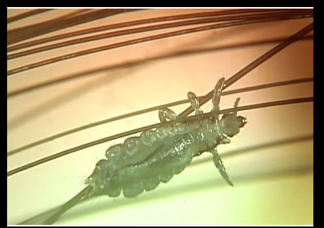 CDC Changes Lice Guidelines: Students With Nits Do Not Need to be Sent Home