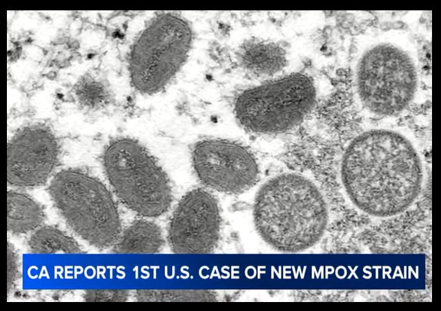 California Confirms Nation’s First Case of Virulent Clade 1 Monkeypox
