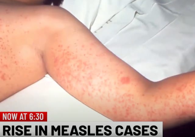 Measles Outbreak the Worst in 25 Years With Over 1,000 Cases
